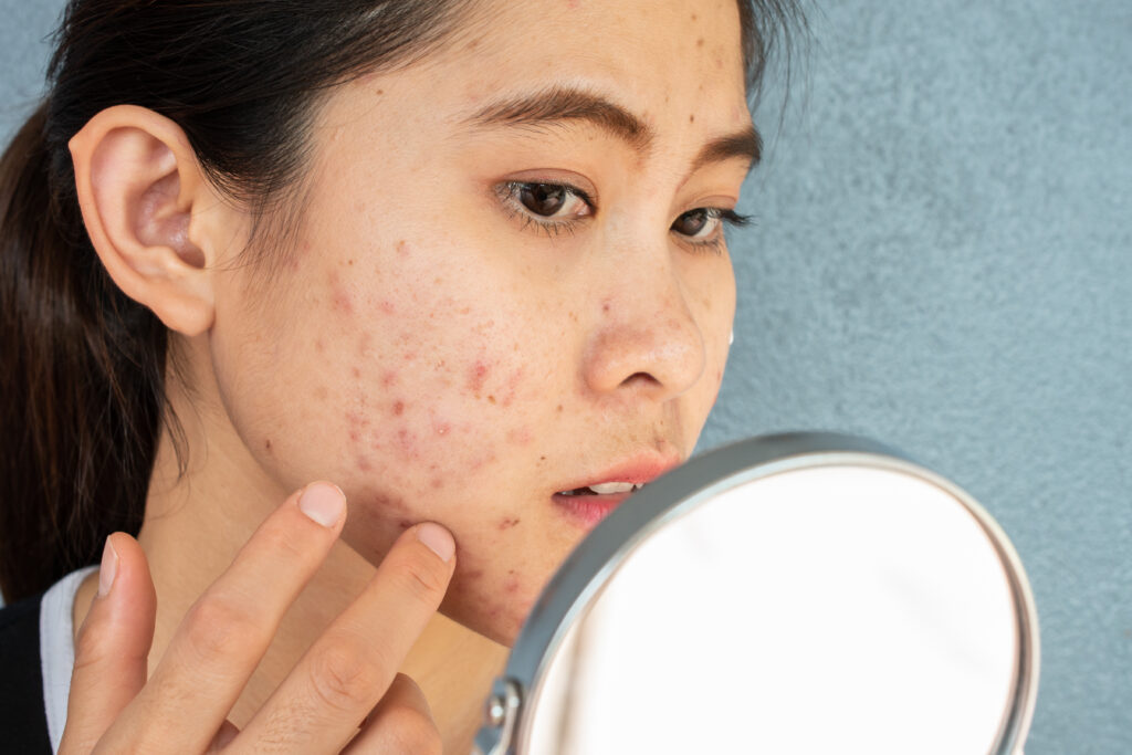 Can You Clear Acne on Your Own? | Skin And Cancer Institute