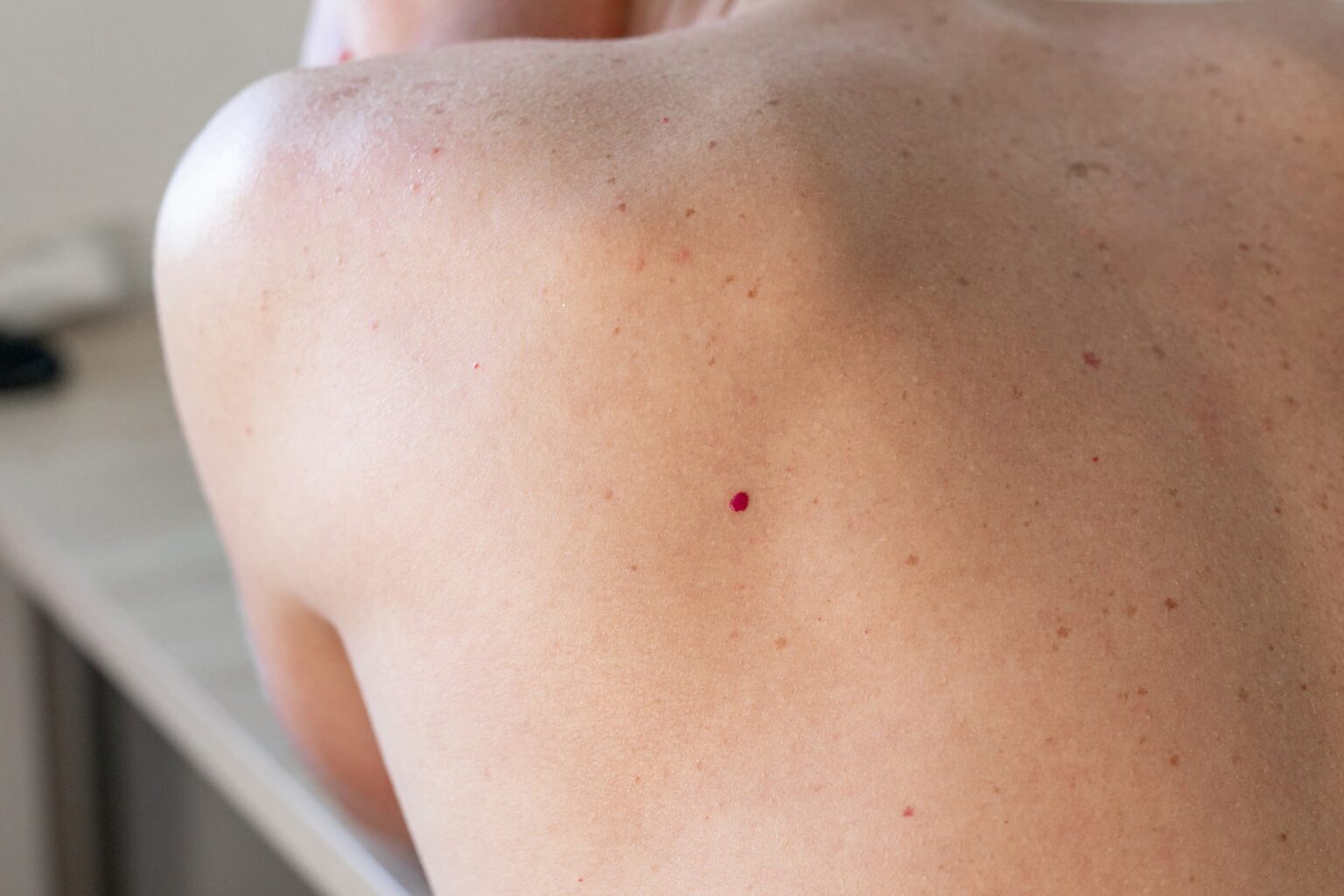 Angioma Removal Services | LA Skin Center | Skin And Cancer Institute