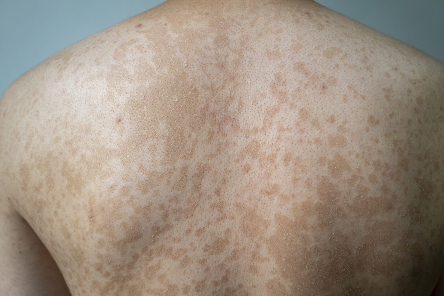 Everything You Need to Know About Tinea Versicolor & Tinea Versicolor ...