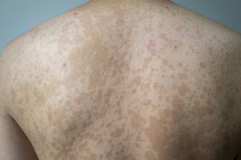 Everything You Need to Know About Tinea Versicolor & Tinea Versicolor ...