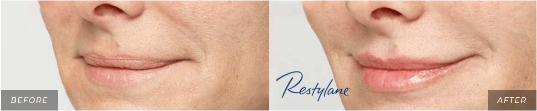 Restylane Fillers | Gallery | Skin And Cancer Institute