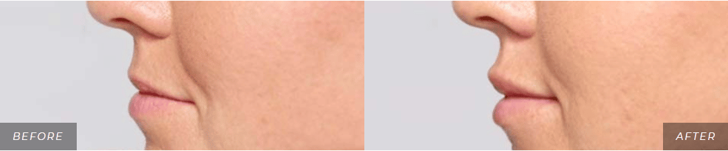 Restylane Fillers | Gallery | Skin And Cancer Institute