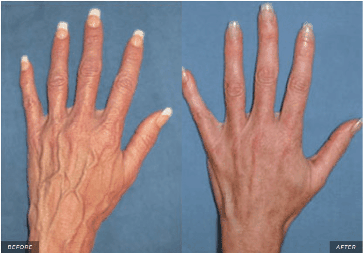 Before & After Photos of Sclerotherapy Treatment | Skin And Cancer ...