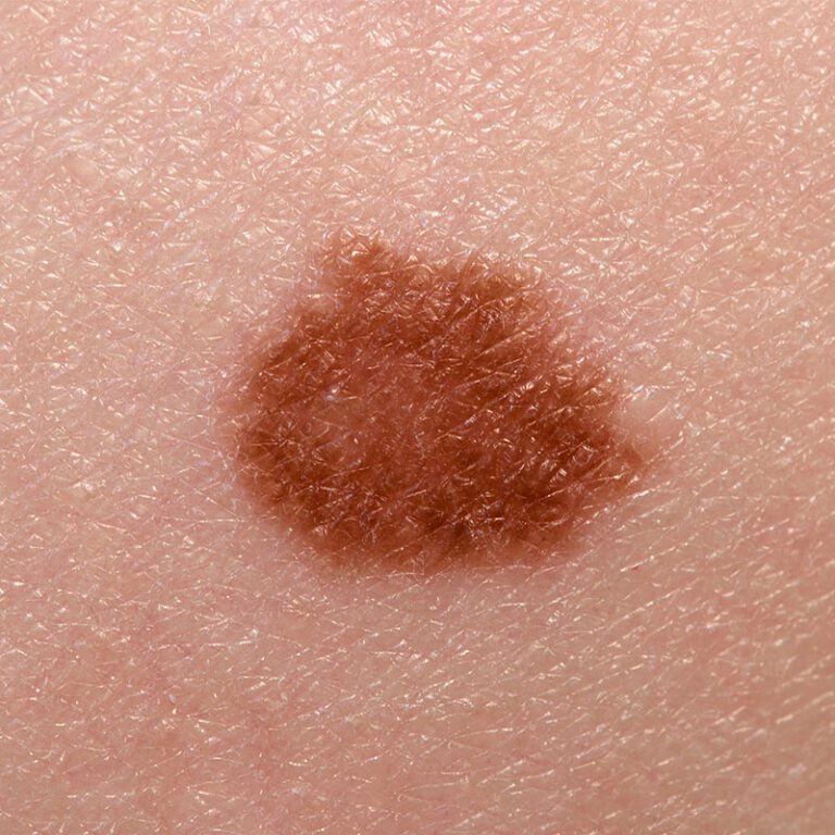 Skin Cancer | Dermatology & Skin Cancer Experts | Skin And Cancer Institute