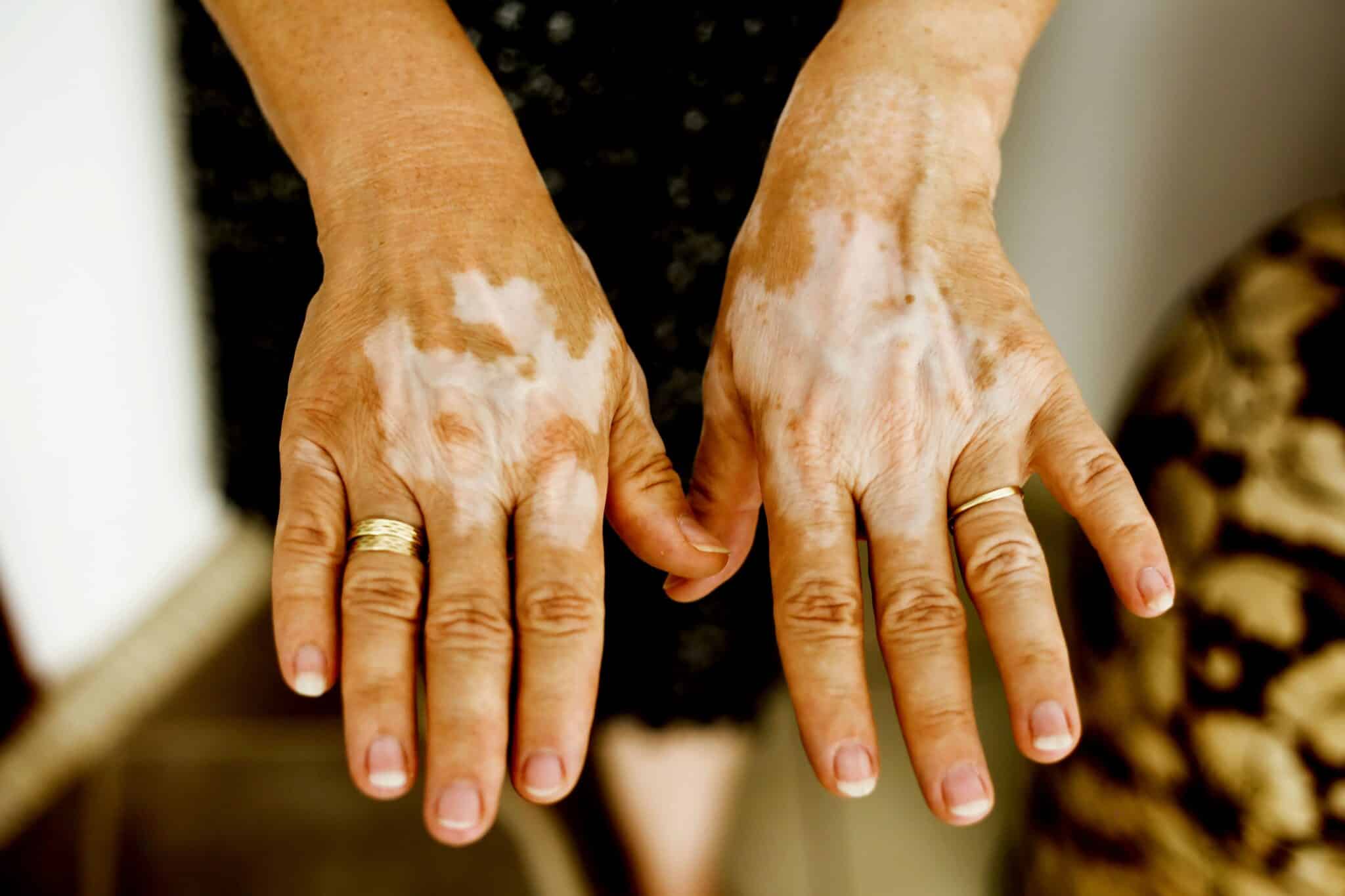 Vitiligo: causes, treatments, and coping strategies | Skin And Cancer ...