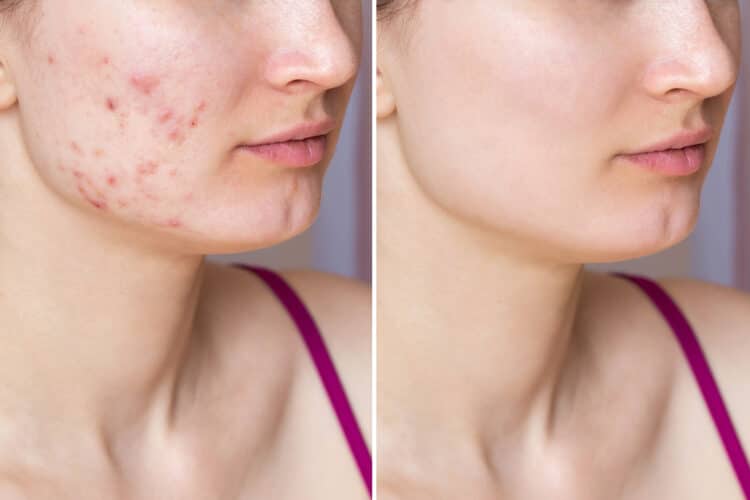 ACNE - Reasons to See a SCI Dermatologist for Acne Treatment | Skin And ...