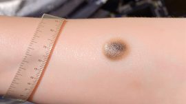 The Importance of Regular Skin Checks: Spotting Early Signs of Skin ...